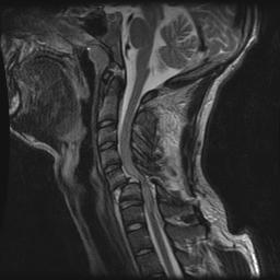 Cervical Facet Dislocations & Fractures - Spine - Orthobullets